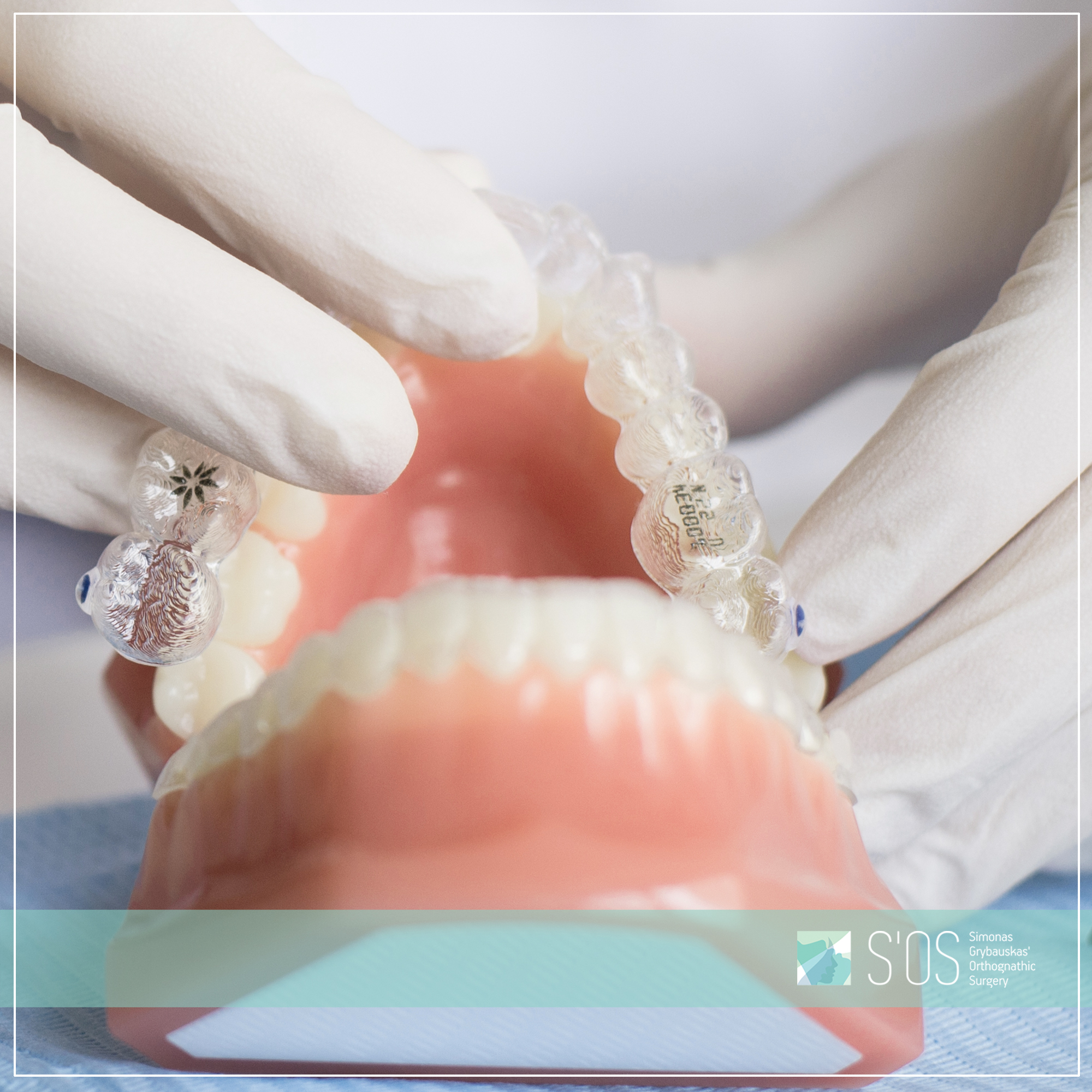 Permatomos dantų tiesinimo kapos - ortodontijos naujovė - SOS klinika