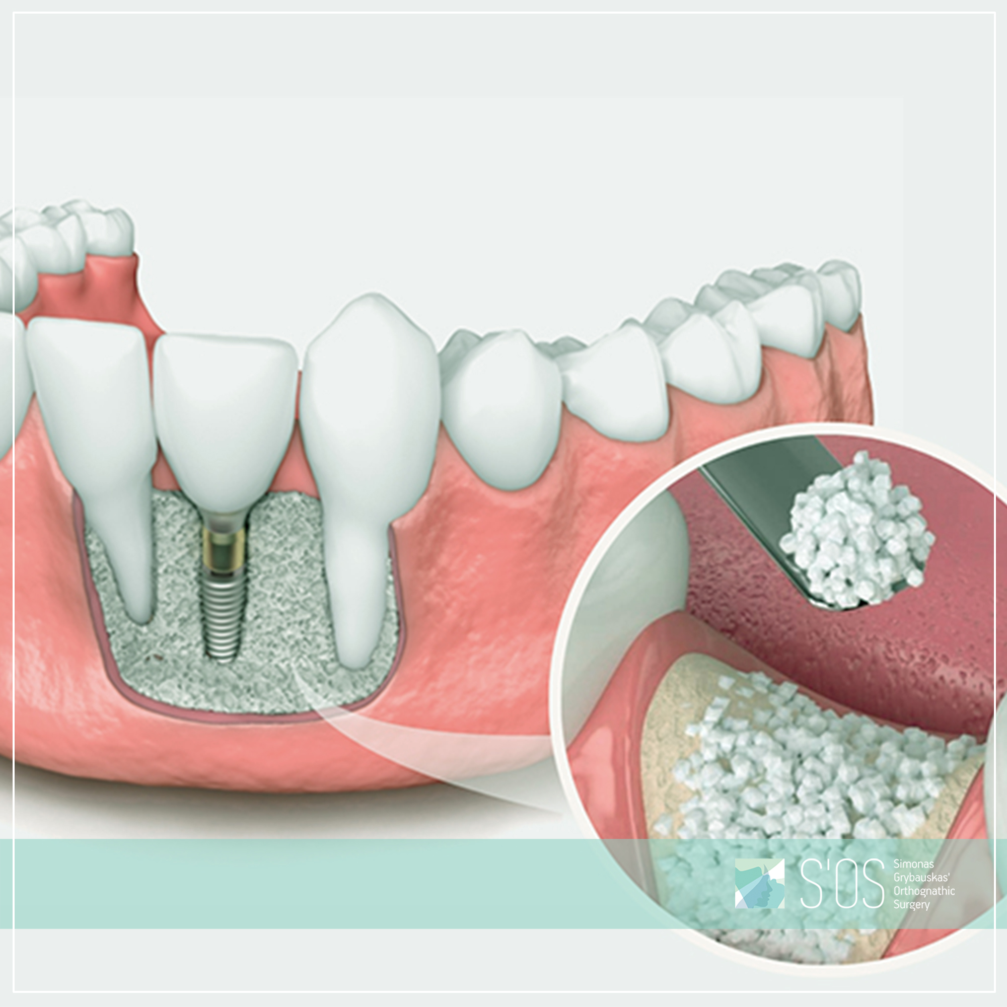 Kaulo augmentacija – kokia tai procedūra? | S'OS klinika Vilniuje
