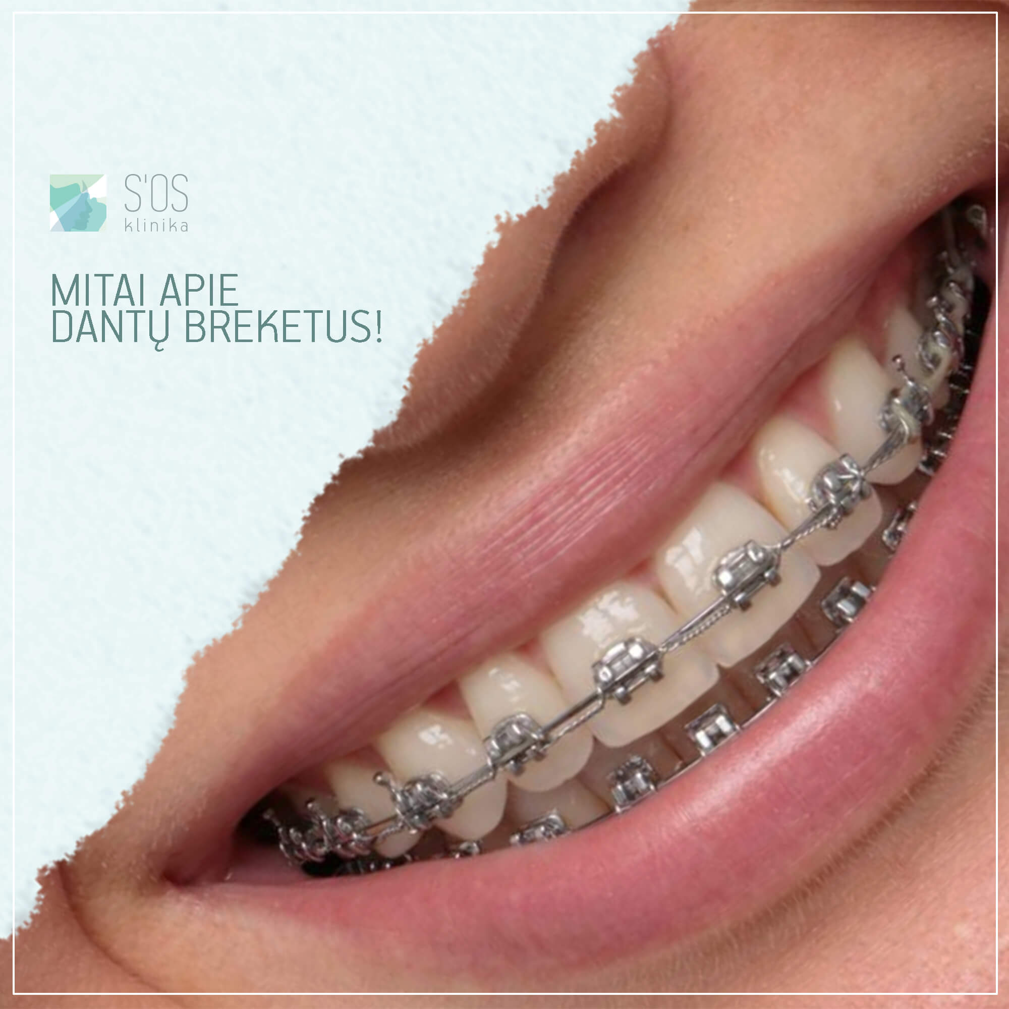 Mitai apie dantų tiesinimą BREKETAIS!