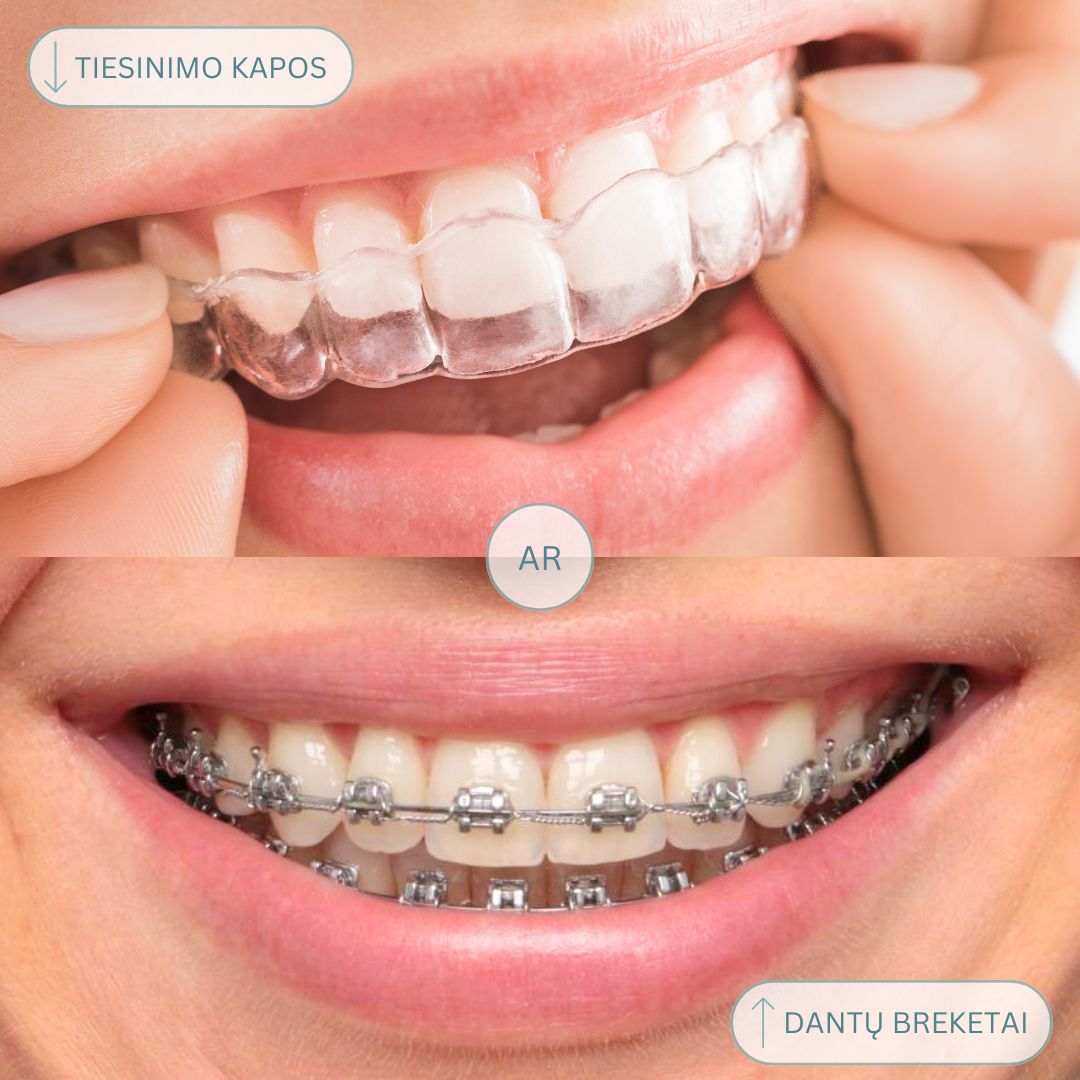Breketai ar dantų tiesinimo kapos? | Pataria S'OS klinika