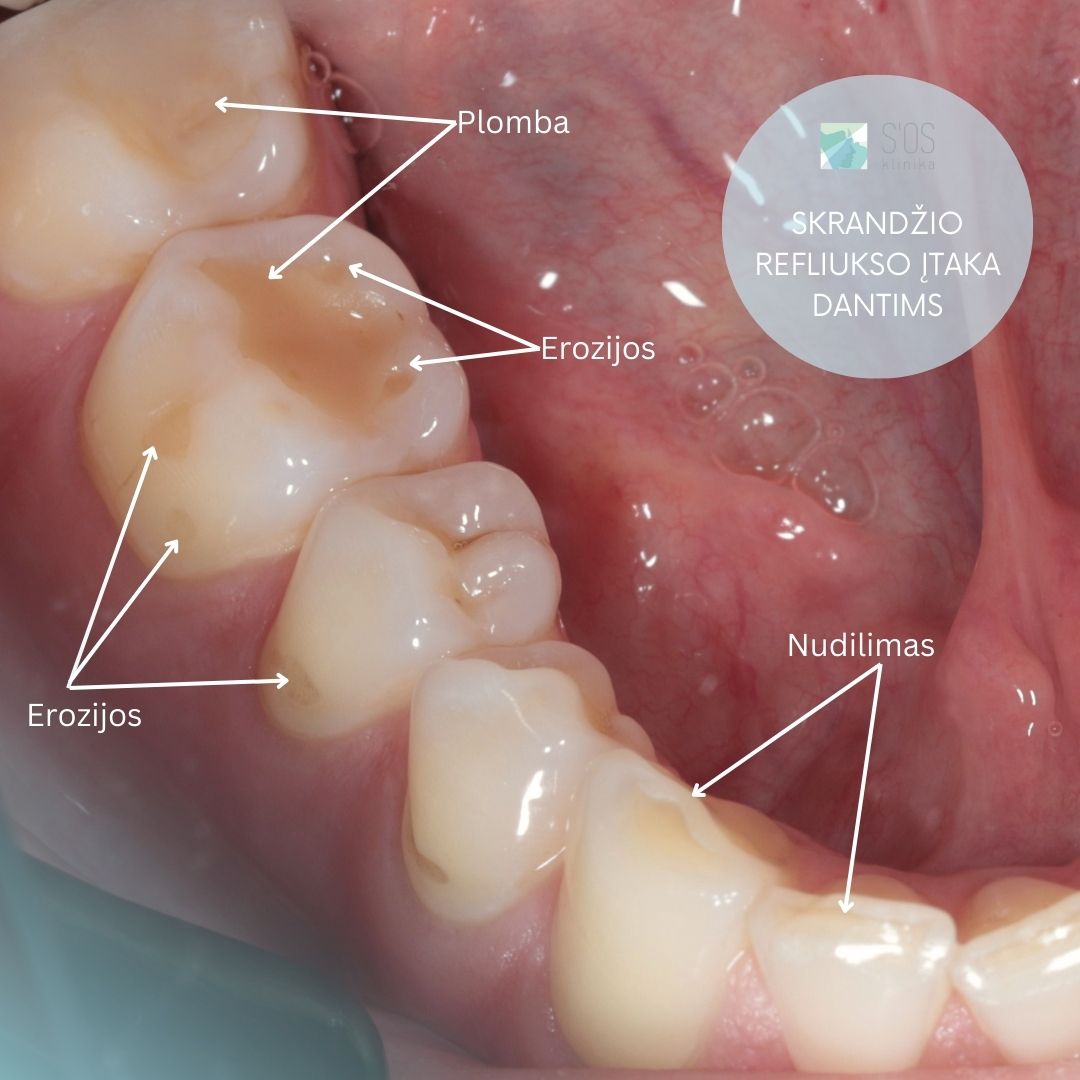 Padidėjęs skrandžio rūgštingumas (refliuksas): kaip jis veikia mūsų dantis?